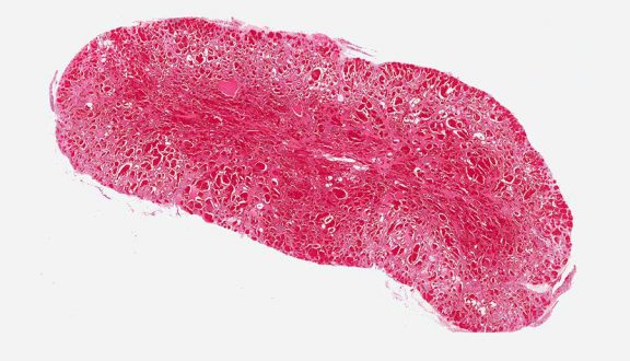 Acantosis, acantólisis y disqueratosis | Fundación Piel Sana AEDV