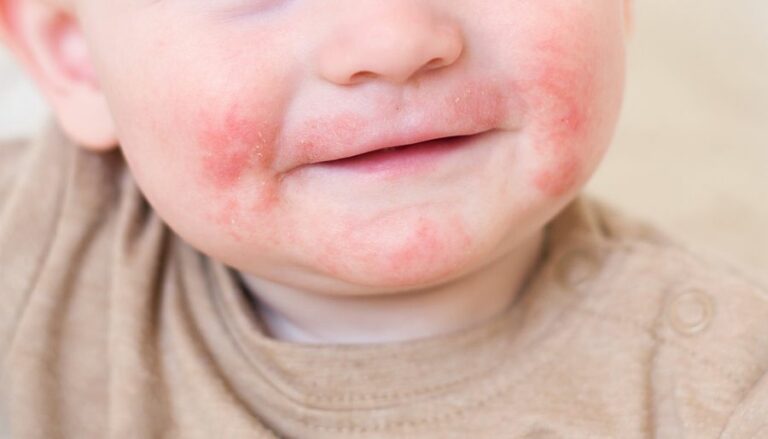 Dermatitis atópica: No es un problema menor | Fundación Piel Sana AEDV